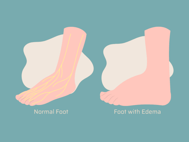 Best Compression Boots for Edema: Top Models for Effective Swelling ...